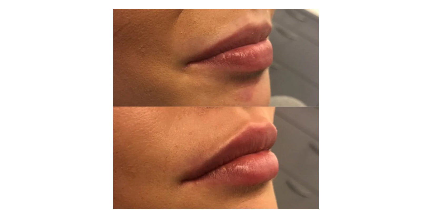 Restylane Lepper – Medisinsk Hudklinikk